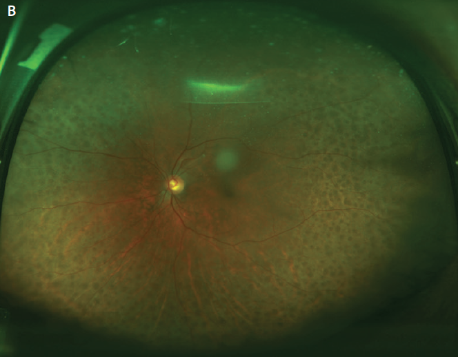 Management of Uveal Effusion Syndrome - Retina Today