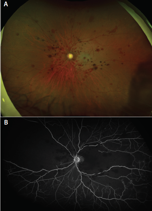 Getting a Good Look at Uveitis With Multimodal Imaging - Retina Today