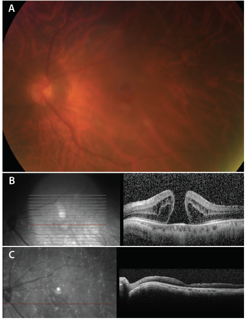 One Procedure, Two Uses - Retina Today