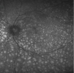 Management of Uveal Effusion Syndrome - Retina Today