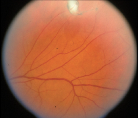 Getting a Good Look at Uveitis With Multimodal Imaging - Retina Today
