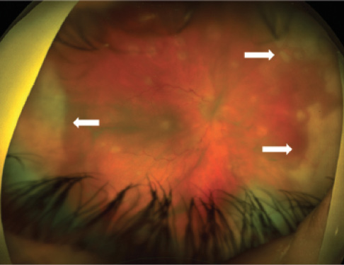 Getting a Good Look at Uveitis With Multimodal Imaging - Retina Today