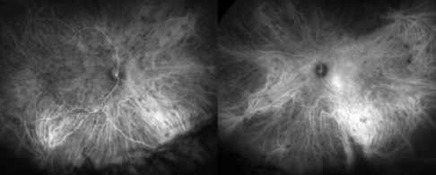 Getting a Good Look at Uveitis With Multimodal Imaging - Retina Today