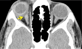 Post-Traumatic Optic Nerve Avulsion With Central Retinal Artery ...