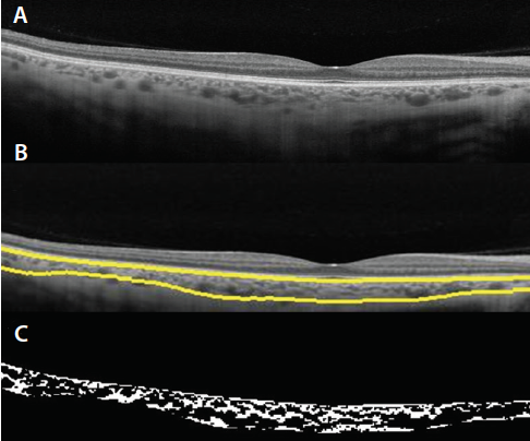 New Ways to Image the Choroid - Retina Today