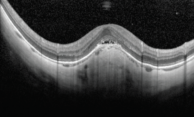 New Ways to Image the Choroid - Retina Today