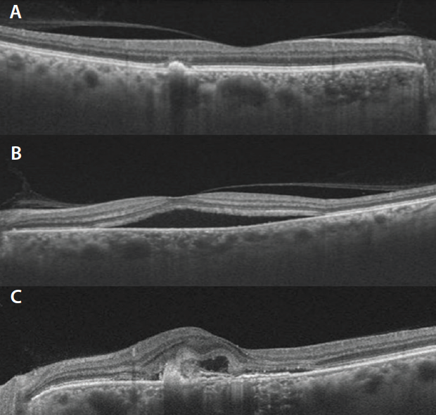 New Ways to Image the Choroid - Retina Today
