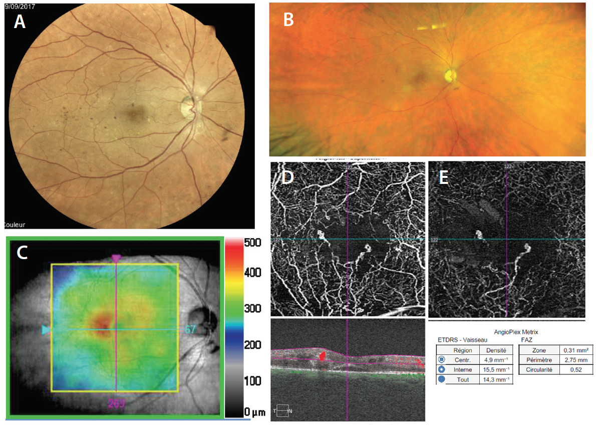 How OCTA Has Changed Retina Practice - Retina Today