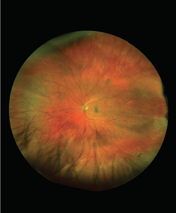 Going Ultra-Wide - Retina Today