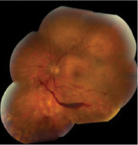 Proliferative Retinopathy Secondary to Chronic Myelogenous Leukemia ...