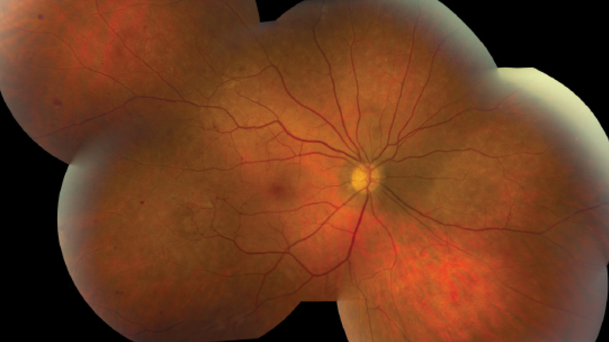 Proliferative Retinopathy Secondary to Chronic Myelogenous Leukemia ...