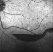 Proliferative Retinopathy Secondary to Chronic Myelogenous Leukemia ...