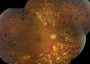 Proliferative Retinopathy Secondary to Chronic Myelogenous Leukemia ...