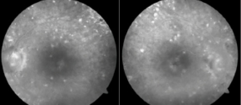 Graying Eyelashes, Hearing Loss, and Blurry Vision: Aging or ...