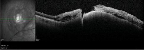 Advanced Management of Small Uveal Melanoma - Retina Today
