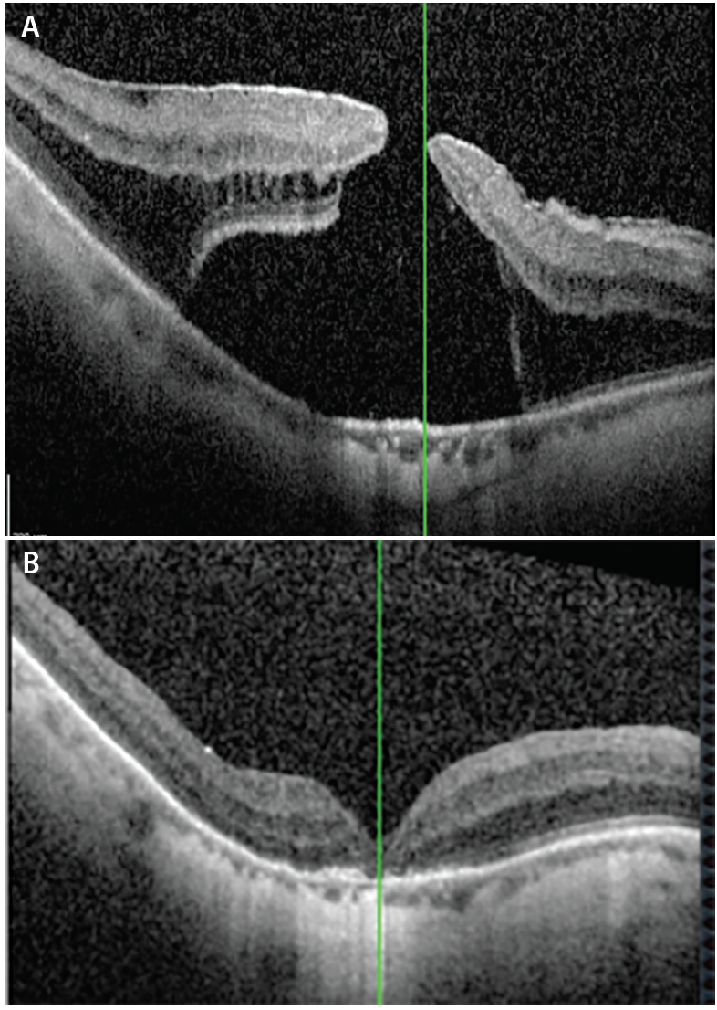 Use of Autologous Blood in Macular Hole Surgery - Retina Today