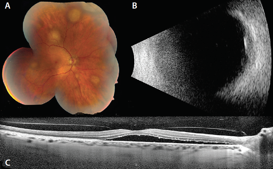 PDT as Primary Therapy for Choroidal Metastases From Carcinoid Tumor ...