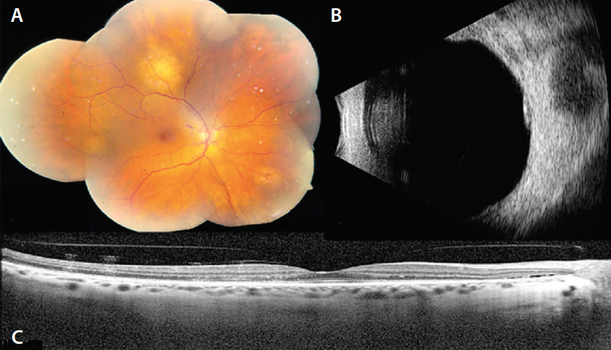 PDT as Primary Therapy for Choroidal Metastases From Carcinoid Tumor ...