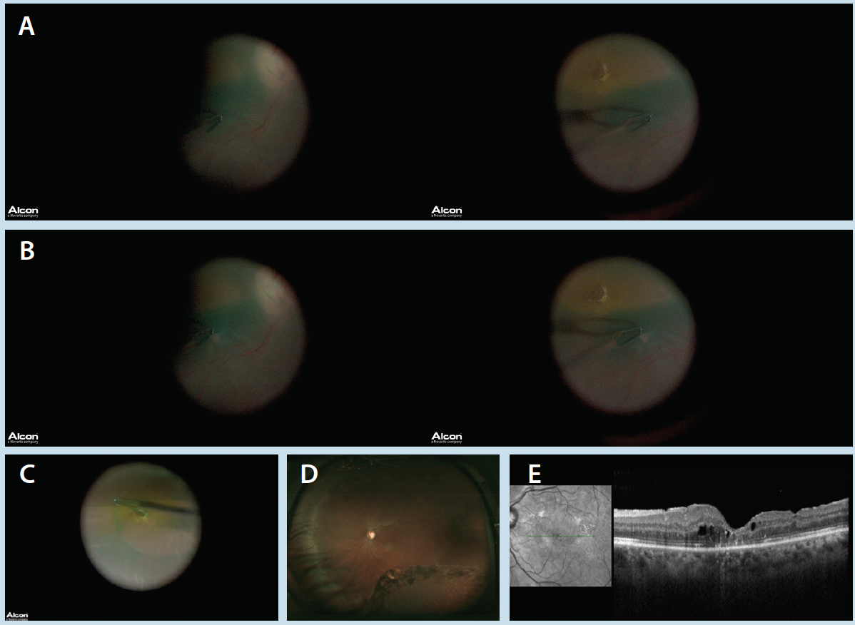 Management of Rhegmatogenous Retinal Detachment with Macular Hole ...