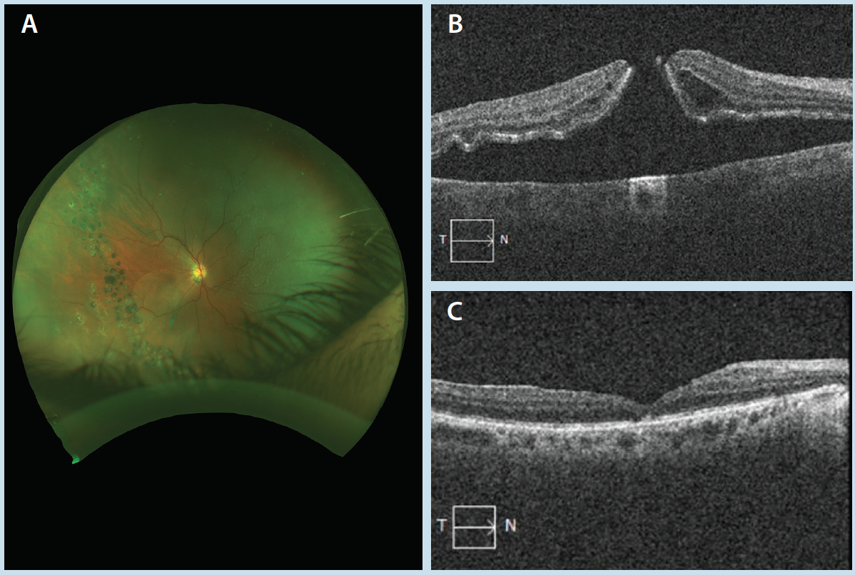 Management of Rhegmatogenous Retinal Detachment with Macular Hole ...
