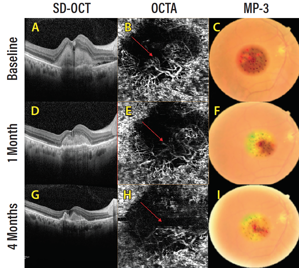 Correlation of OCT Angiography and Microperimetry in Wet AMD - Retina Today