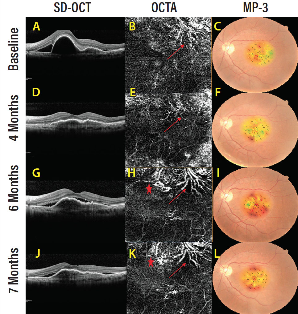 Correlation of OCT Angiography and Microperimetry in Wet AMD - Retina Today