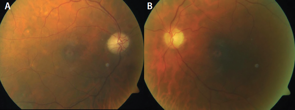Imaging in Hydroxychloroquine Toxicity - Retina Today