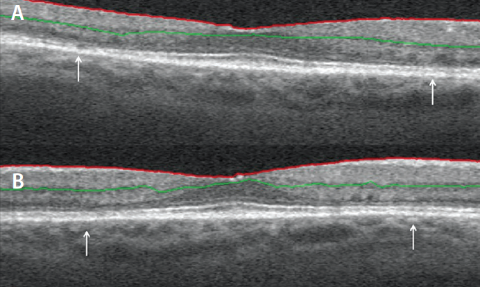 Imaging in Hydroxychloroquine Toxicity - Retina Today