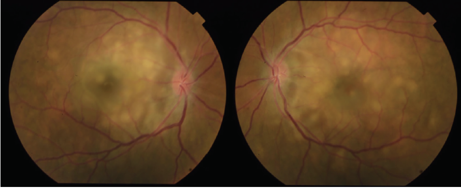 Unexpected Tuberculosis Laboratory Result: The Creation of a Treatment ...