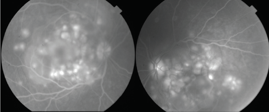 Unexpected Tuberculosis Laboratory Result: The Creation of a Treatment ...