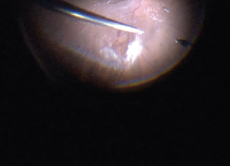 Full Thickness Macular Hole Repair in a Patient With Proliferative ...