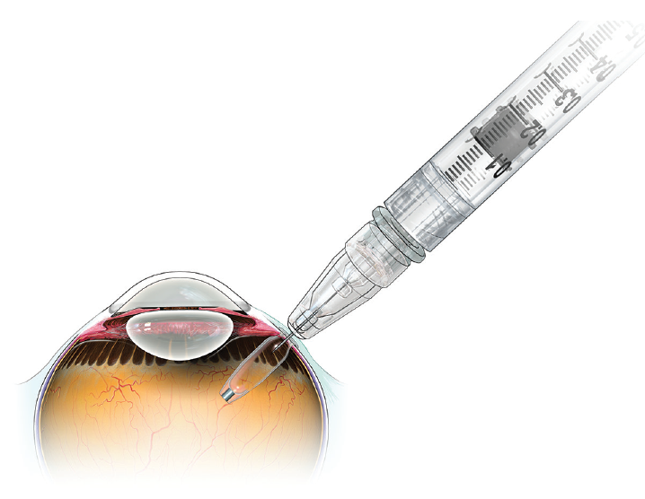 Use of the Port Delivery System in AMD - Retina Today