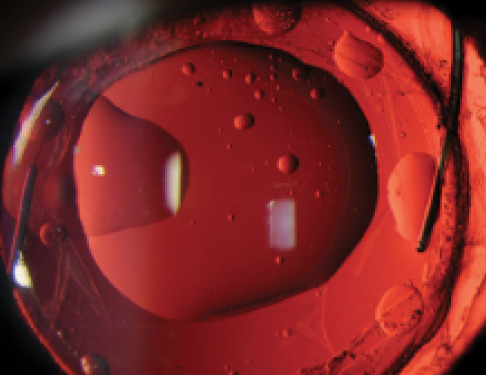 IOLs: What Retina Subspecialists Need to Know - Retina Today