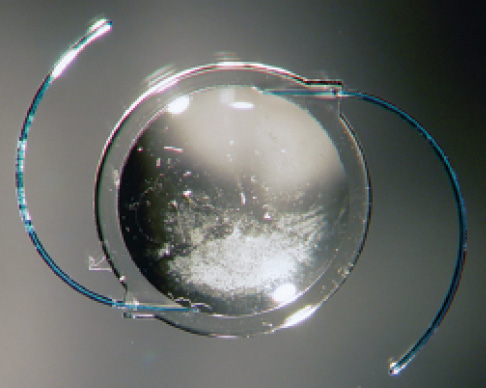 IOLs: What Retina Subspecialists Need to Know - Retina Today