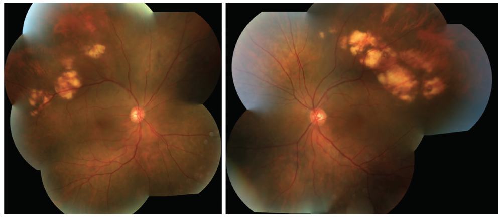 An Urgent Evaluation for Bilateral Elevated Retinal Lesions - Retina Today