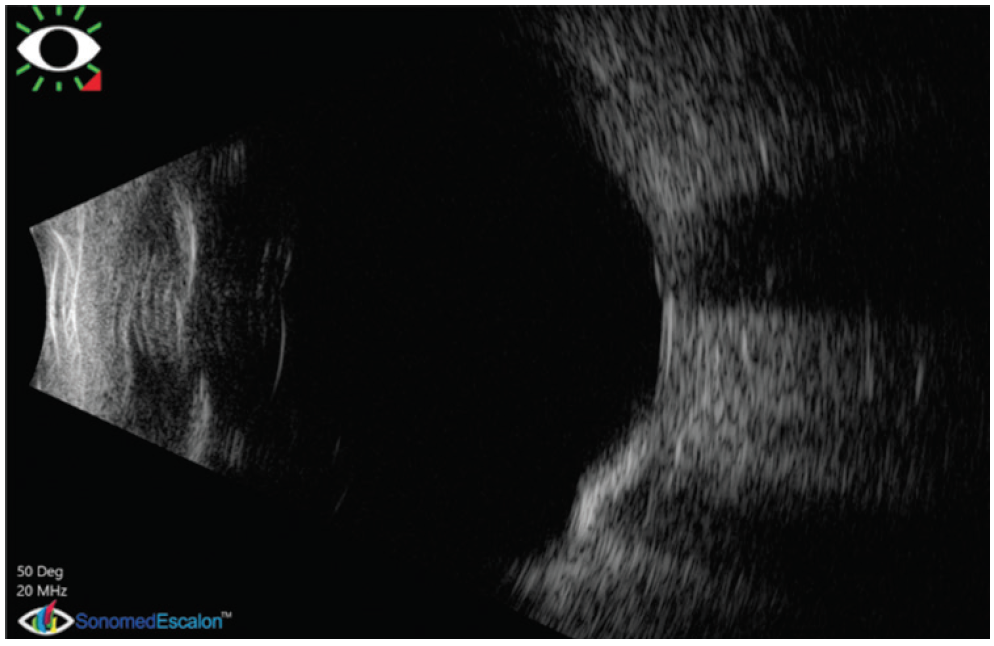 An Urgent Evaluation for Bilateral Elevated Retinal Lesions - Retina Today
