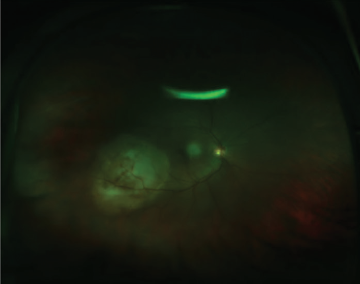 A Choroidal Mass: Rare Presentation of a Metastatic Disease - Retina Today