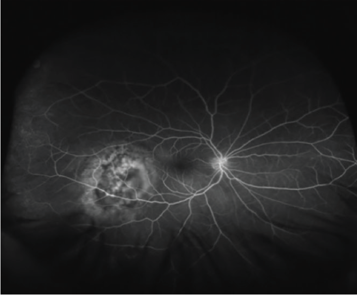 A Choroidal Mass: Rare Presentation of a Metastatic Disease - Retina Today