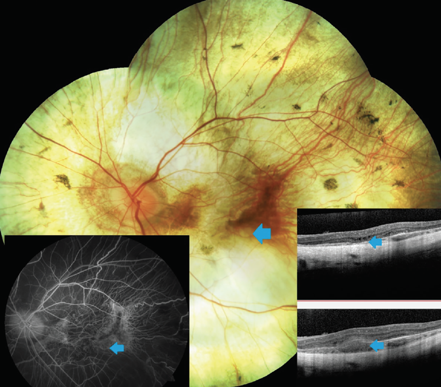 Choroideremia With Choroidal Neovascularisation - Retina Today