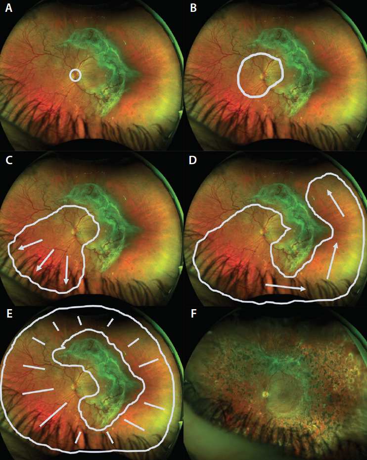 Improving Outcomes in Diabetic Tractional Retinal Detachment Surgery ...