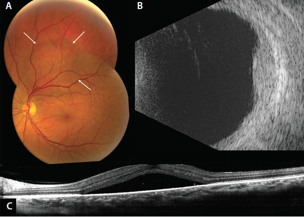 PDT for Circumscribed Choroidal Hemangioma: Does It Work? - Retina Today