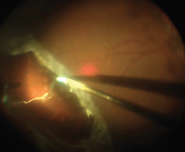 Management of Retinal Detachment Due to Giant Retinal Tear - Retina Today