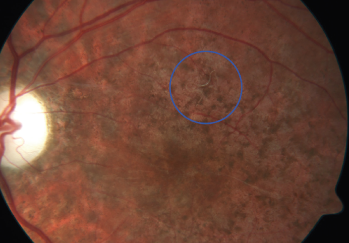 As the Worm Turns - Retina Today