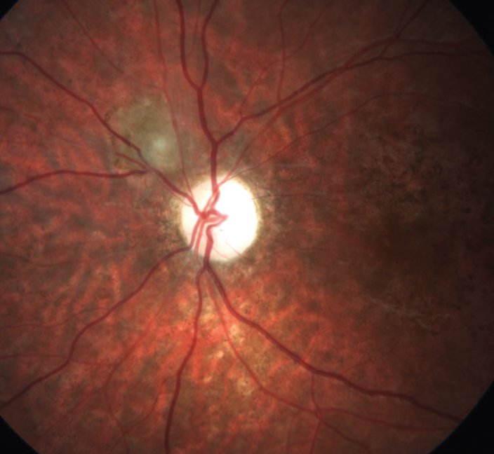 As the Worm Turns - Retina Today