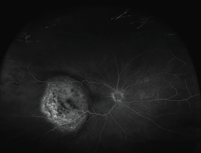 A Choroidal Mass: An Unusual Metastasis With Unusual Treatment - Retina ...