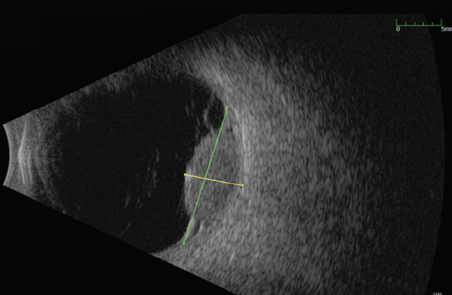 A Choroidal Mass: An Unusual Metastasis With Unusual Treatment - Retina ...