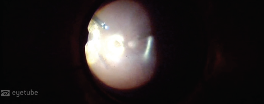 Eyetube Retina Channel Update - Retina Today