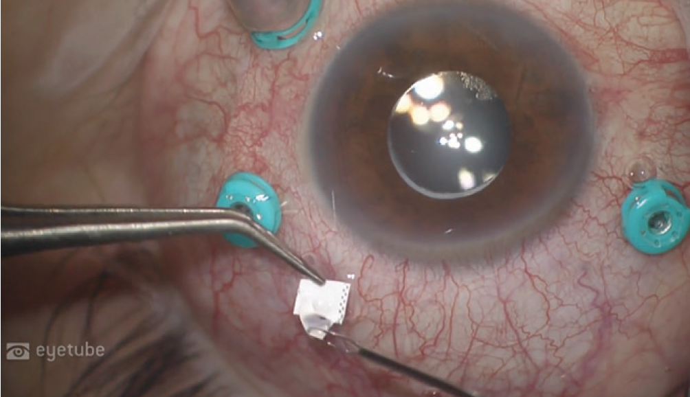 Eyetube Retina Channel Update - Retina Today