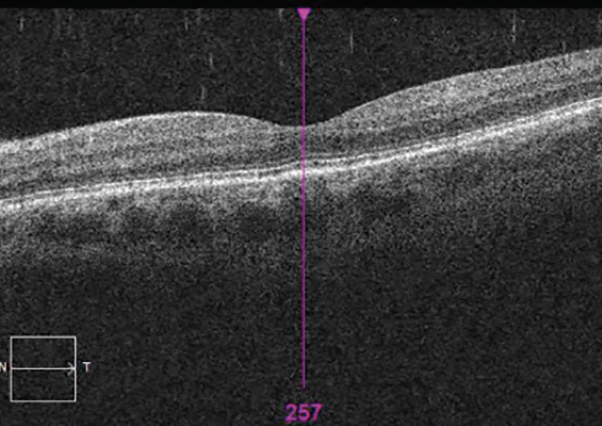 Ophthalmic Manifestations of Neurosyphilis: A Case Report - Retina Today