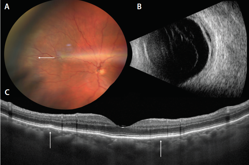 Uveal Effusion Secondary to Hyperviscosity From Chronic Lymphocytic ...